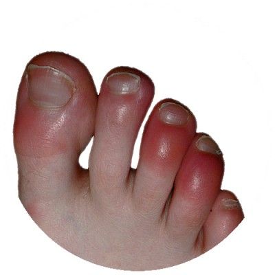 Chilblains - Melbourne Podiatrists & Orthotics